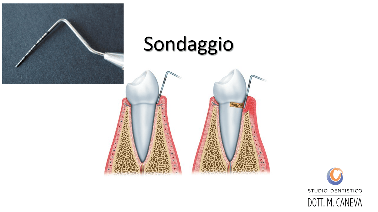 Studio Dentistico Caneva - La Cartella Parodontale: Un Approccio ...